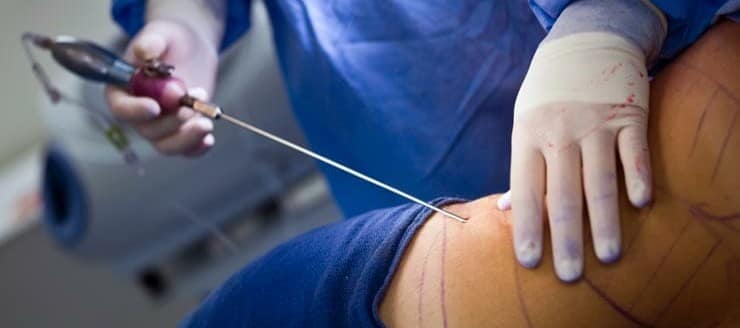 Een Liposuctie: Wat is het en hoeveel kost het?